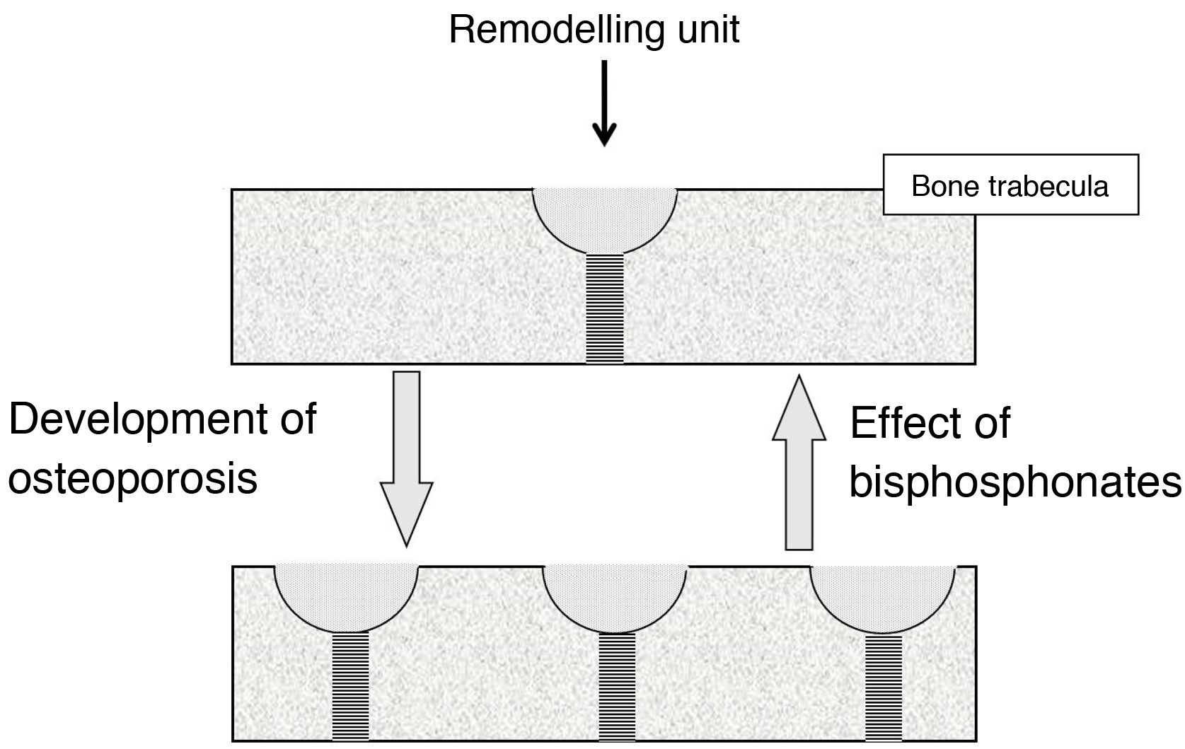 bisphosphonates mechanism of action in osteoporosis