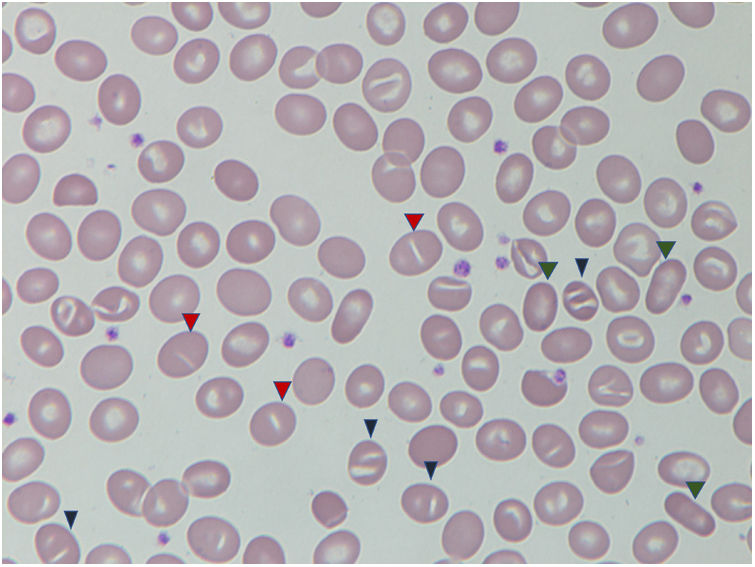 Southeast Asian ovalocytosis | Medicina Clínica (English Edition)