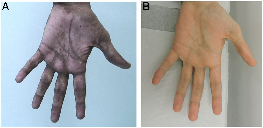 Familial progressive hyperpigmentation: Skin lightening due to imatinib ...