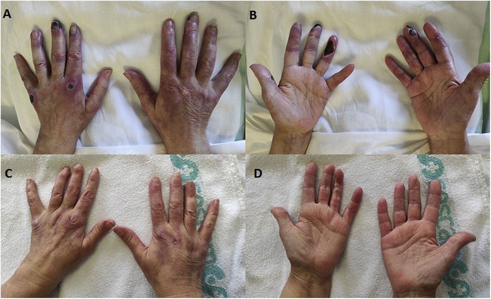 Skin ulcers associated with dermatomyositis MDA5 | Medicina Clínica ...