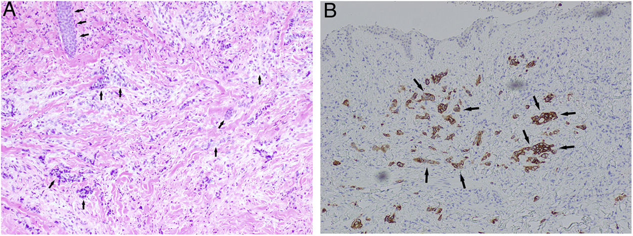 Zosteriform metastases in a patient with lung adenocarcinoma | Medicina ...