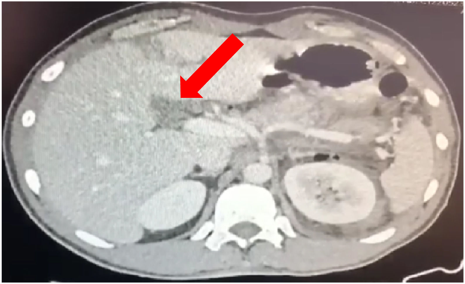 Diagnosis and treatment of pancreatic trauma | Medicina Clínica ...
