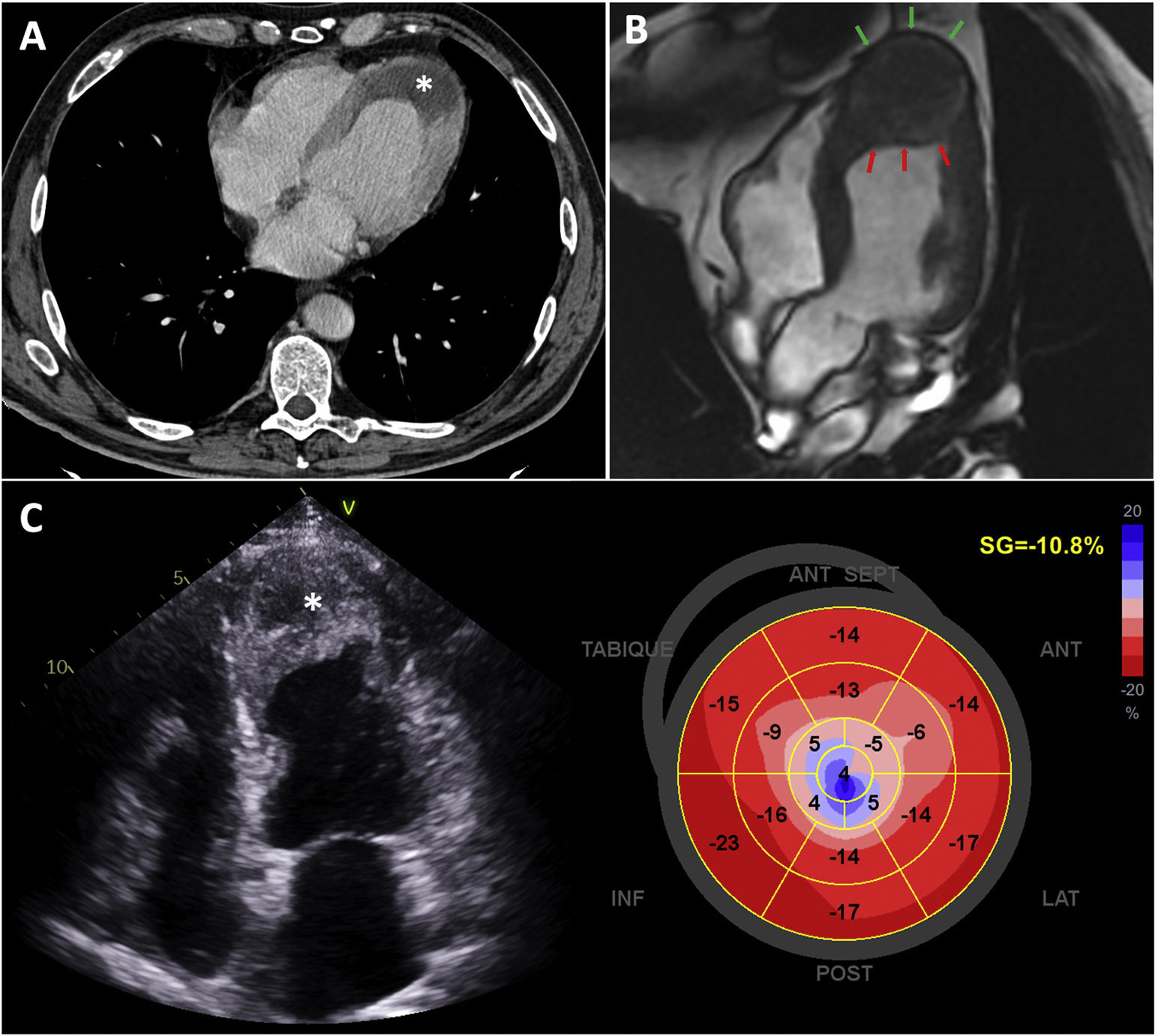 Intramyocardial dissecting hematoma | Medicina Clínica (English Edition)