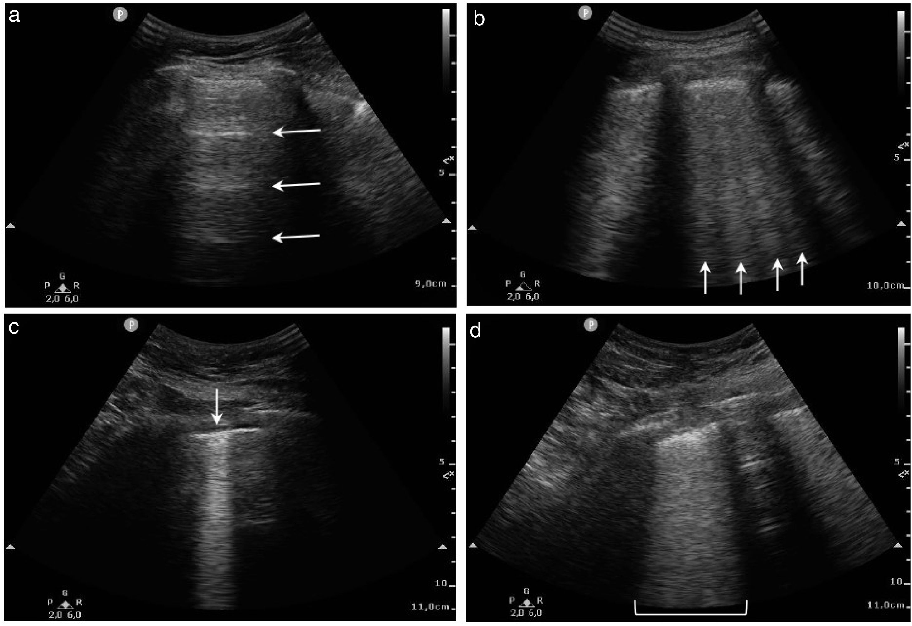 Lung ultrasound score severity cut-off points in COVID-19 pneumonia. A ...