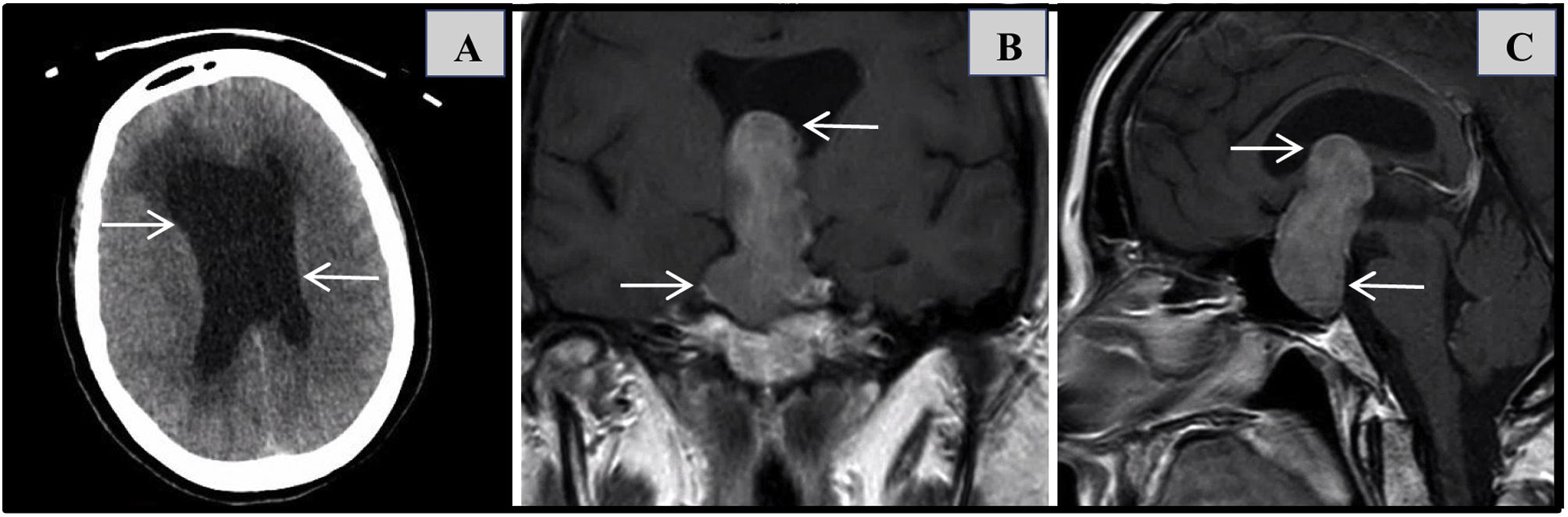 Acute hydrocephalus as an onset form of a pituitary adenoma | Medicina ...