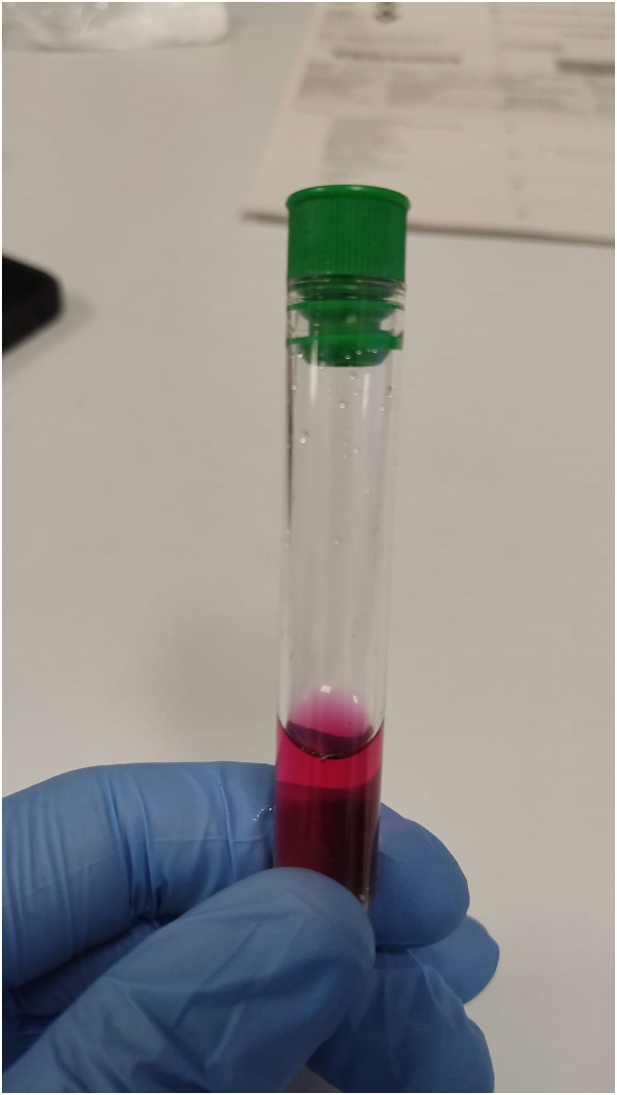 Acute intermittent porphyria: acute flare-up resolved with givosiran ...