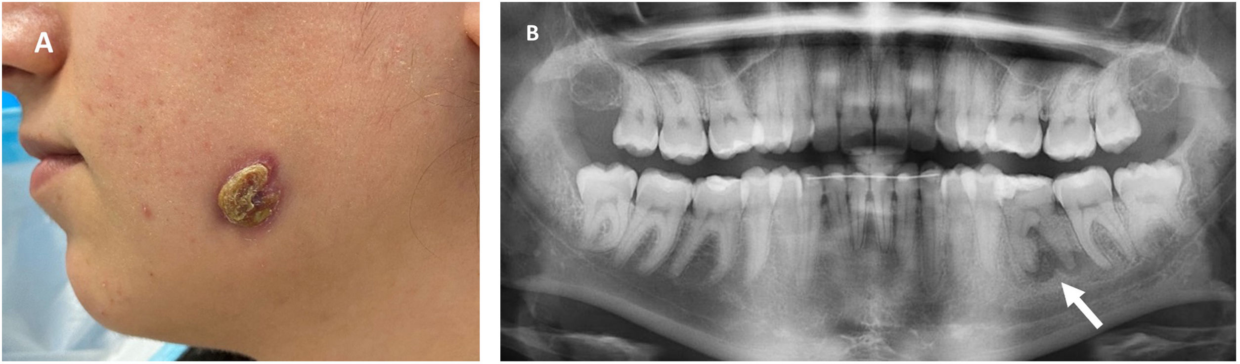 Cutaneous odontogenic fistula | Medicina Clínica (English Edition)