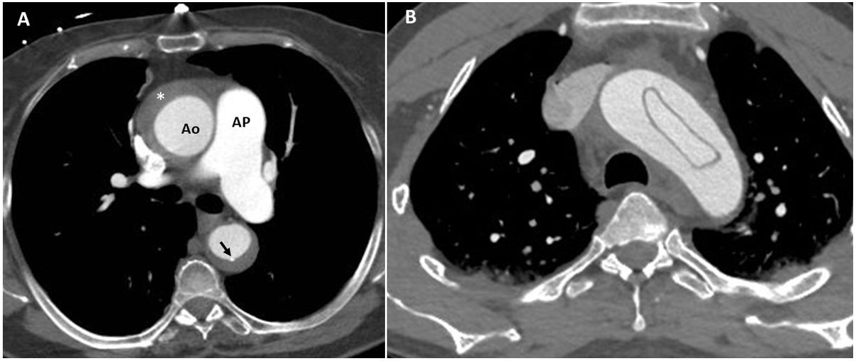 Acute aortic syndrome | Medicina Clínica (English Edition)