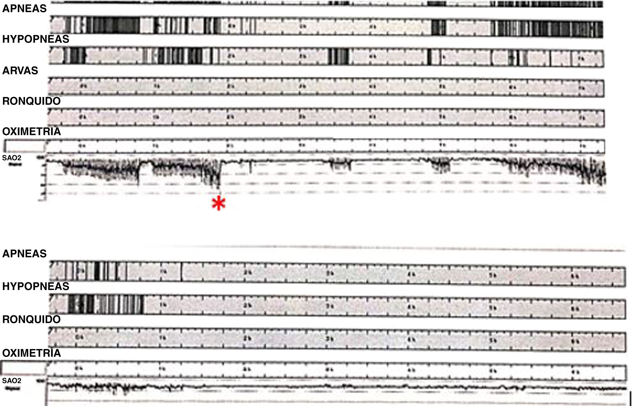 Hypnopompic hallucinations and the sleep apnea–hypopnea syndrome ...