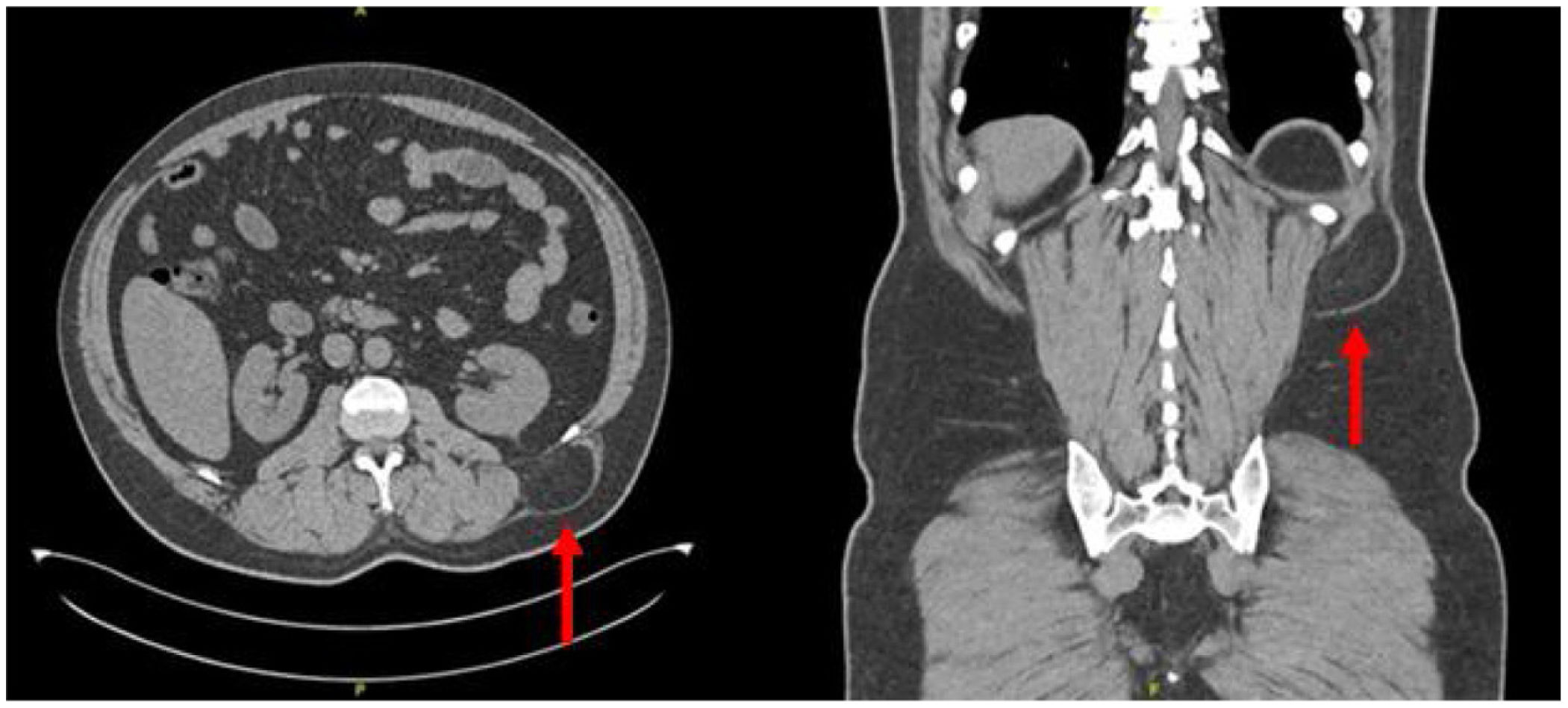 Grynfelt's hernia | Medicina Clínica (English Edition)