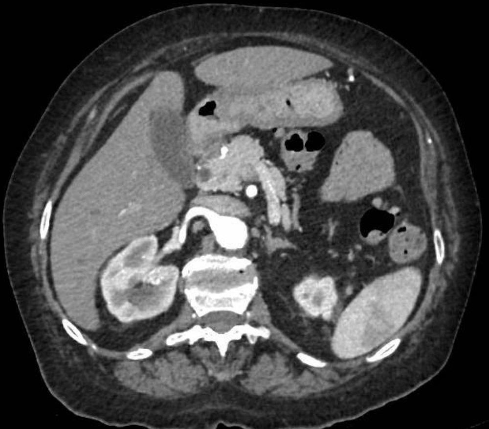 Groove pancreatitis: Case report | Medicina Clínica (English Edition)