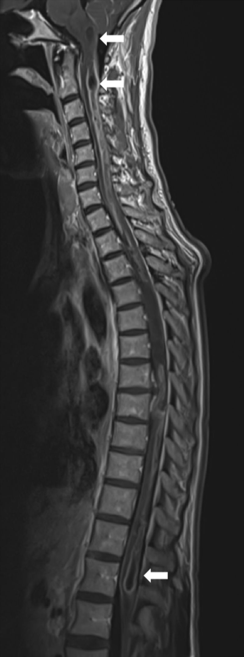 Listeria myelitis in immunocompetent adult patient with a favorable ...