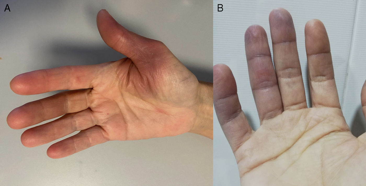 Paroxysmal finger hematoma (Achenbach syndrome): Report of two cases ...