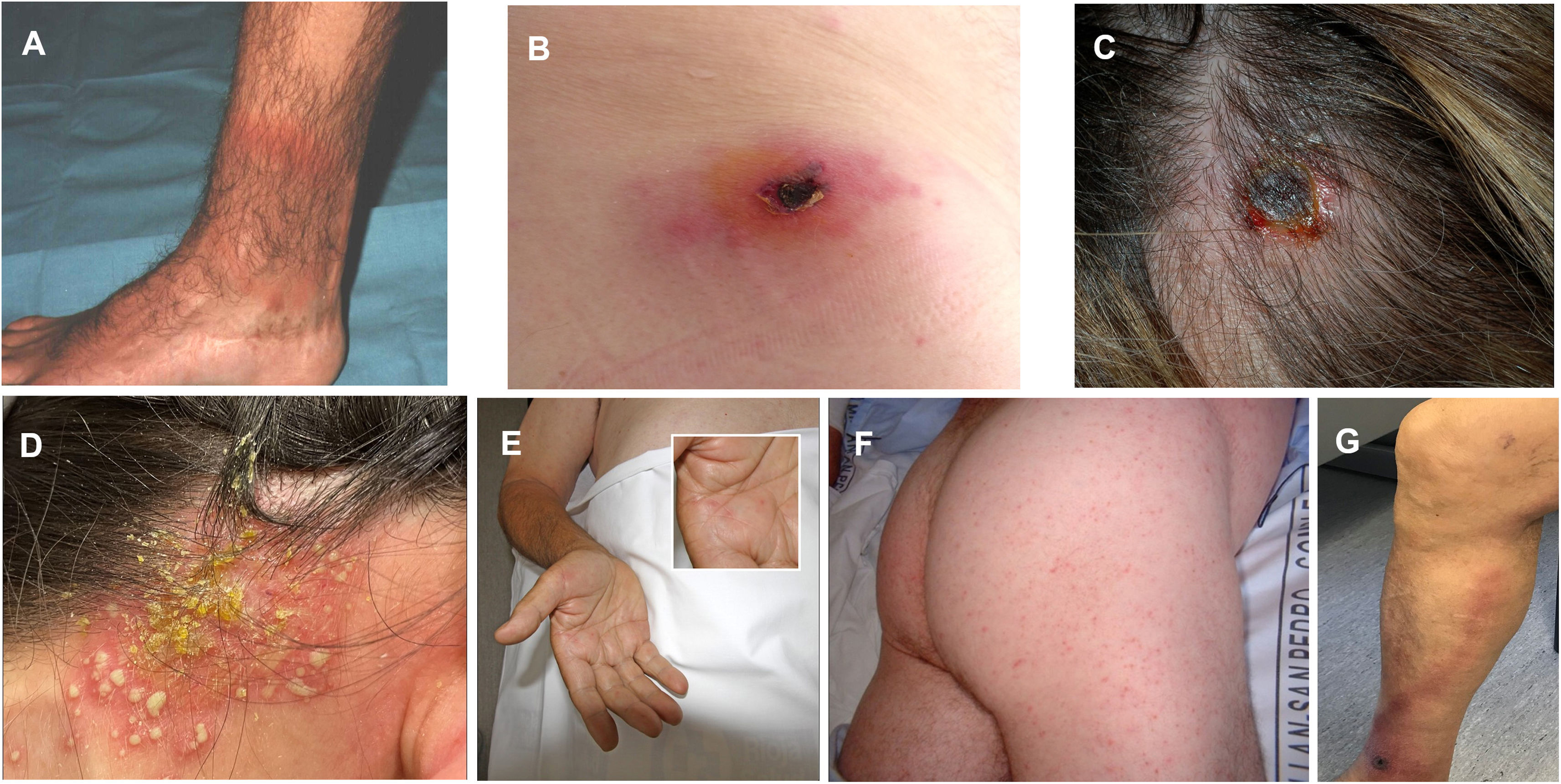 Tick-borne diseases in Spain | Medicina Clínica (English Edition)