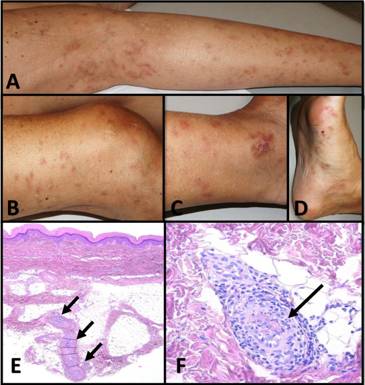 Livedo racemosa secondary to genicular artery embolization in a patient ...