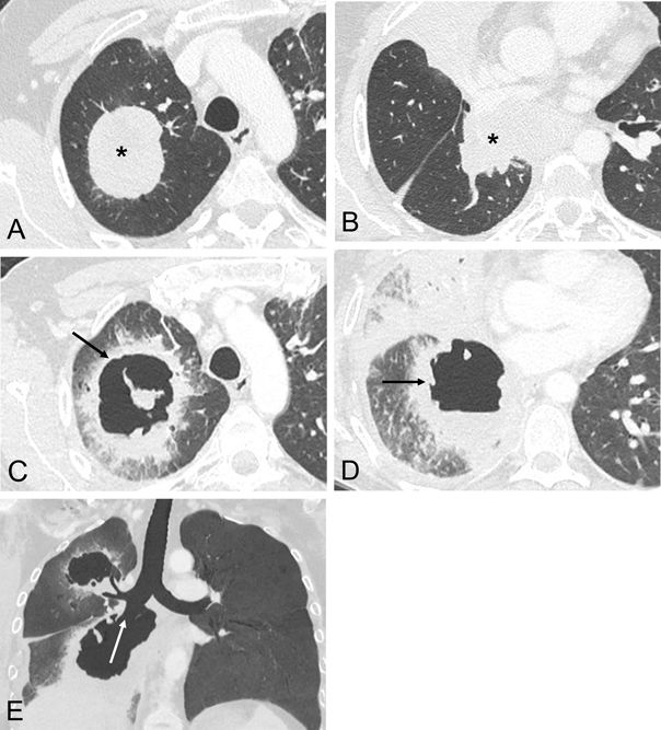 Fatal hemoptysis due to massive cavitation of lung metastases in a ...