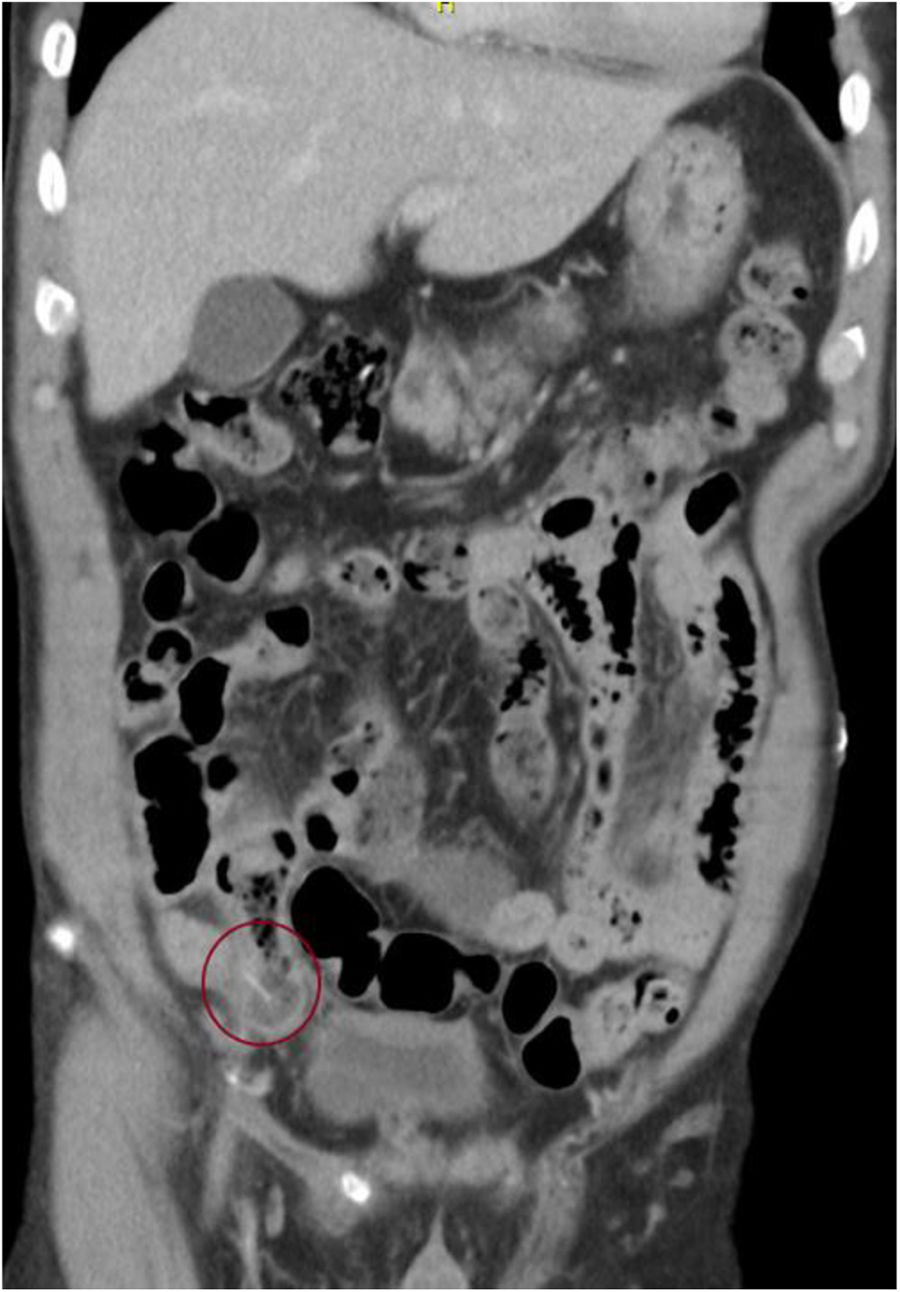 Diverticular perforation due to foreign body | Medicina Clínica ...