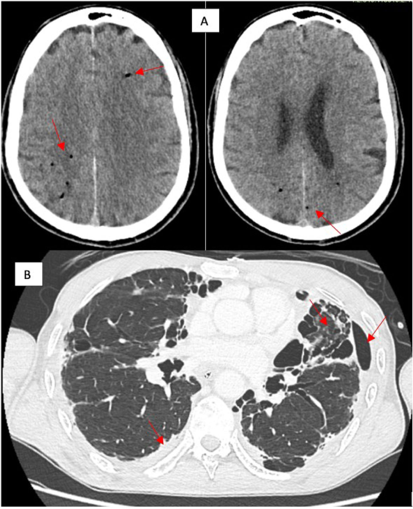 Cerebral air embolism secondary to spontaneous rupture of pulmonary ...