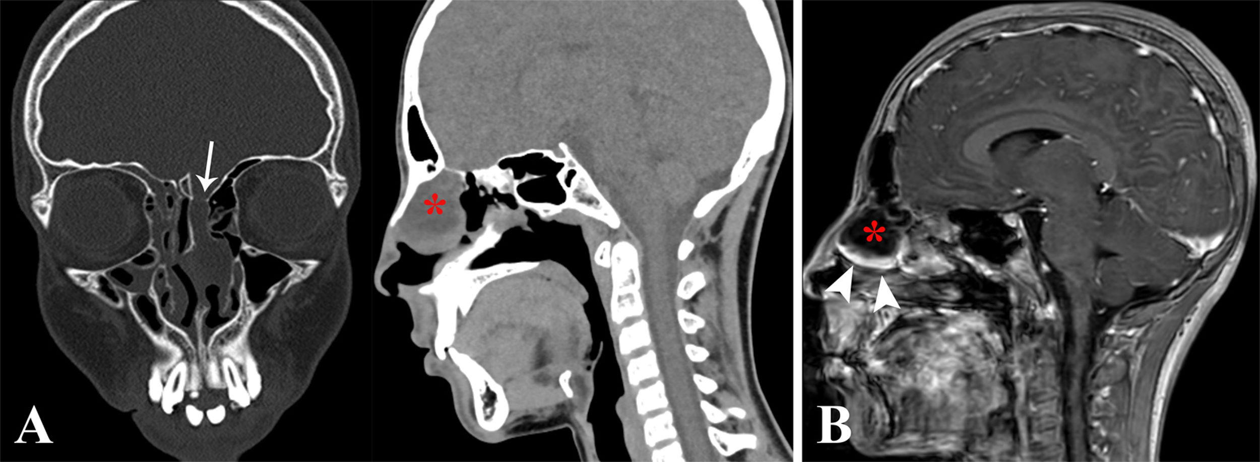 A rare cause of recurrent meningitis | Medicina Clínica (English Edition)