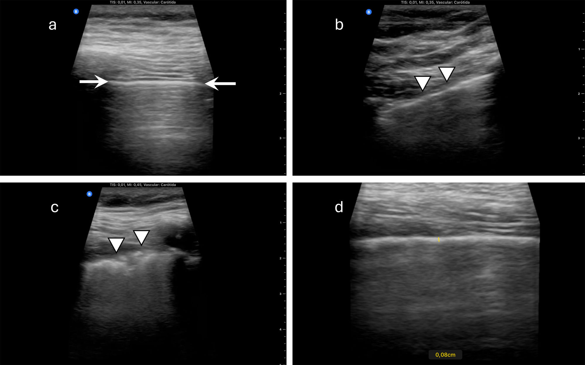 Simplified ultrasound scoring scale (LUNA score) for the detection of ...