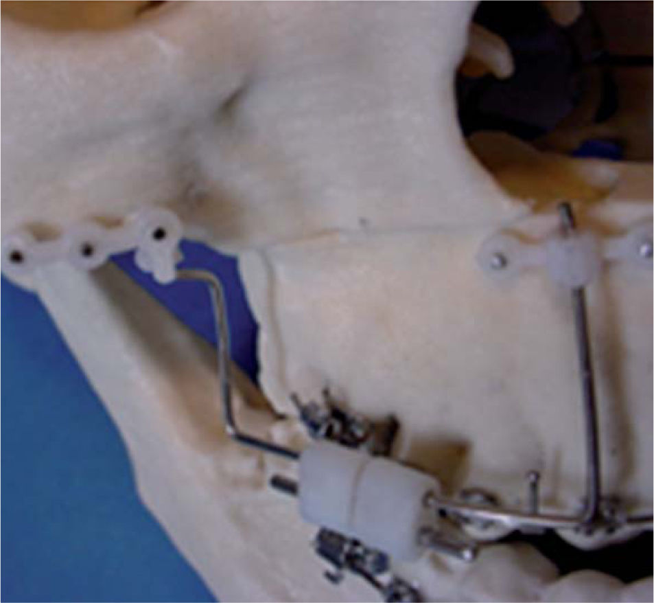 Design of an internal distraction device for maxillary advancement in ...