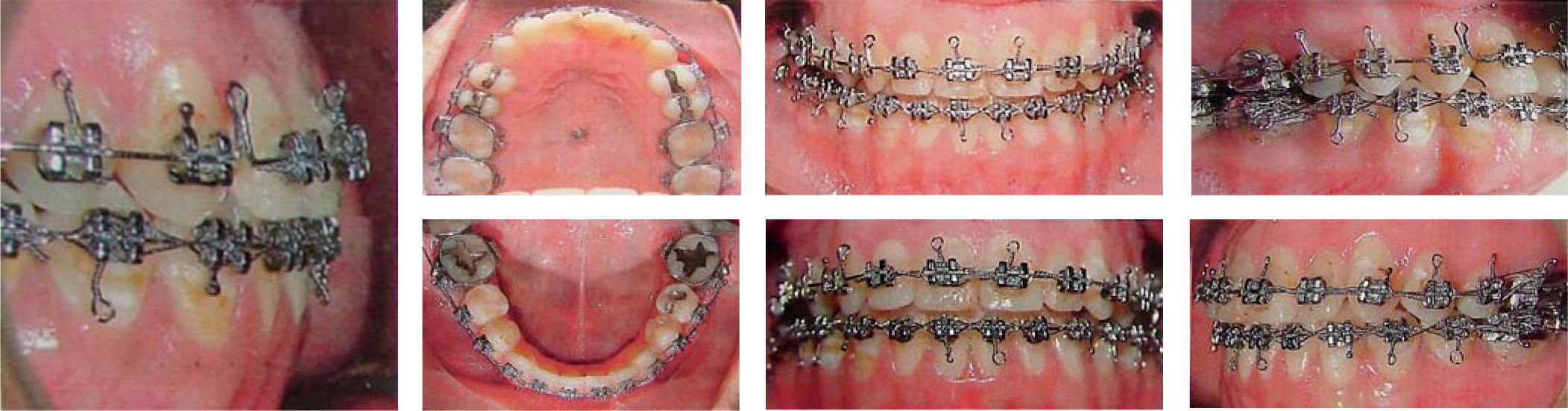 open bite teeth braces
