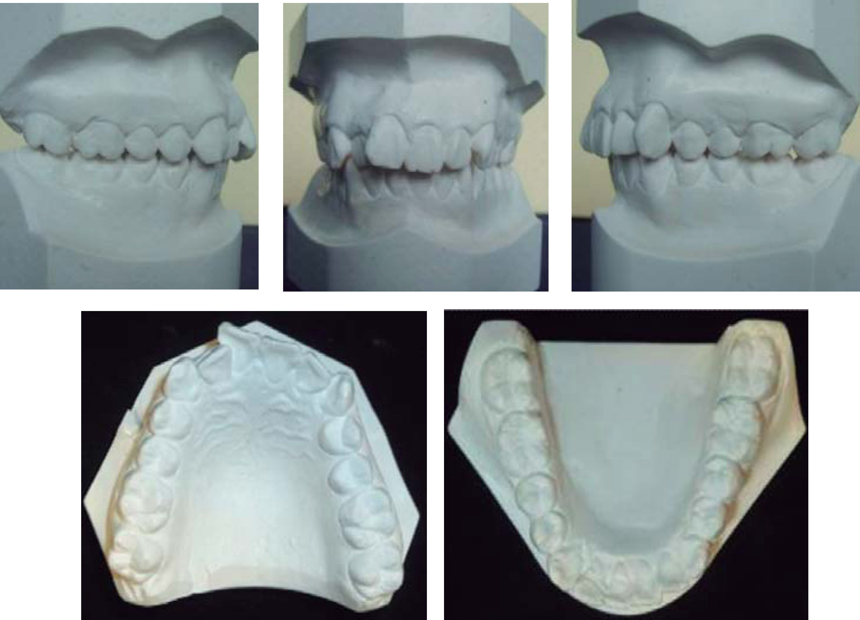 overjet correction with extraction