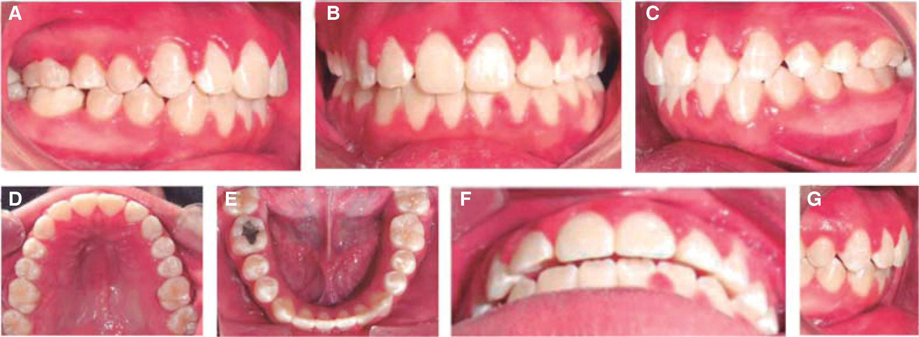 Camouflage orthodontic treatment in an autistic class II patient with ...