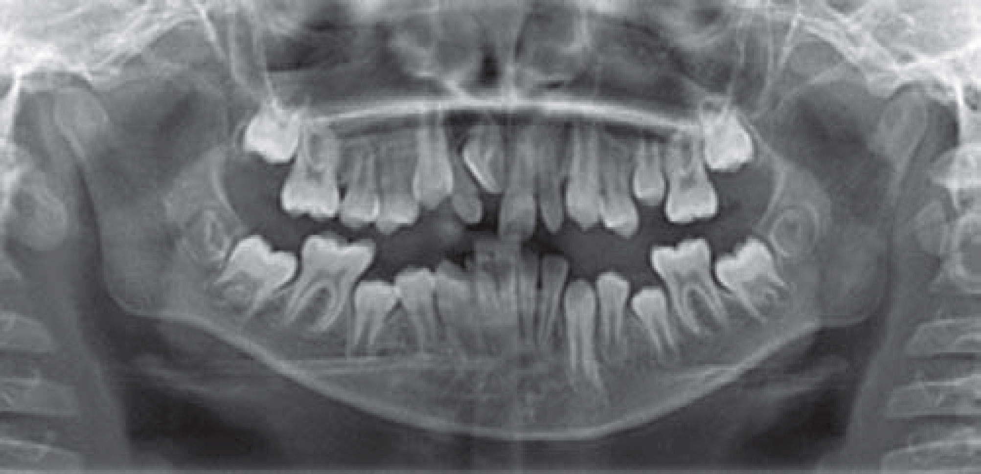 microdontia third molar