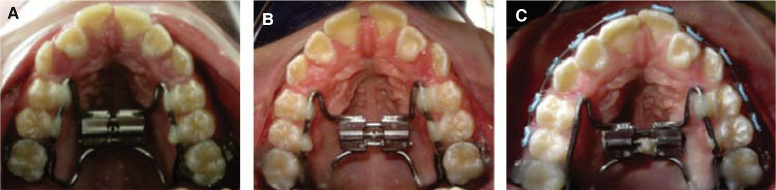 Anterior open bite correction in a skeletal class II patient. Case ...