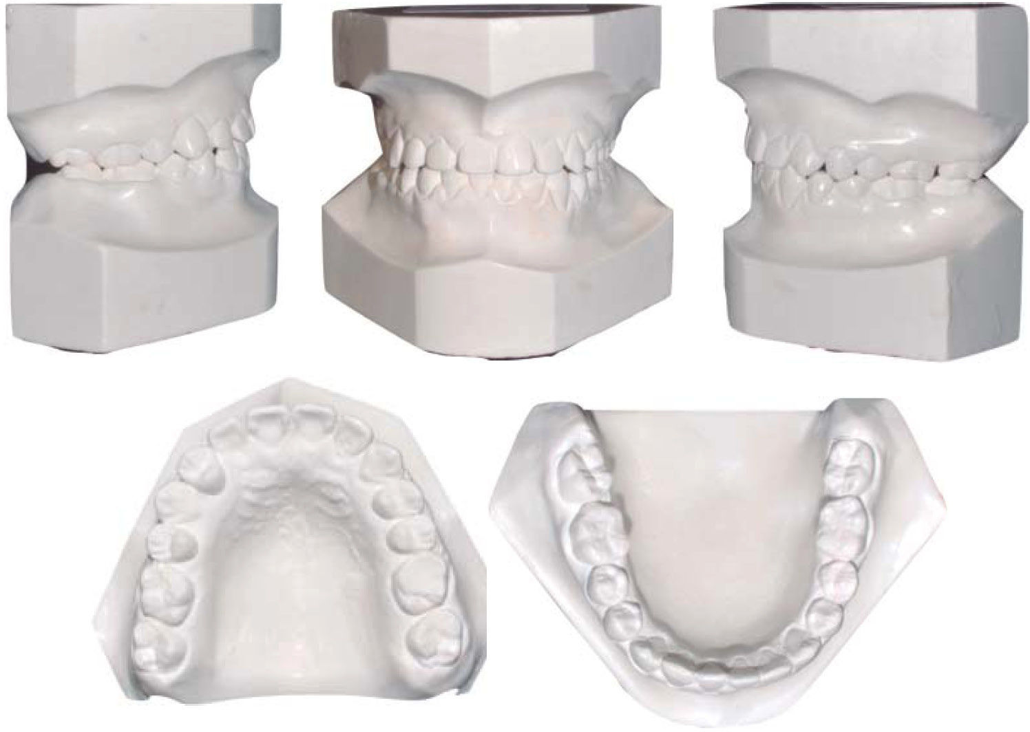 Tratamiento de una clase III esquelética con transposición dental ...
