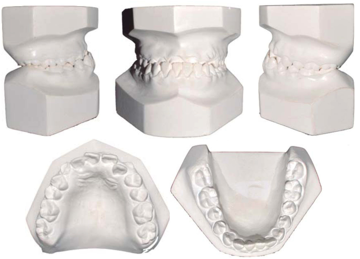 Camouflage treatment of a skeletal class III malocclusion with tooth ...