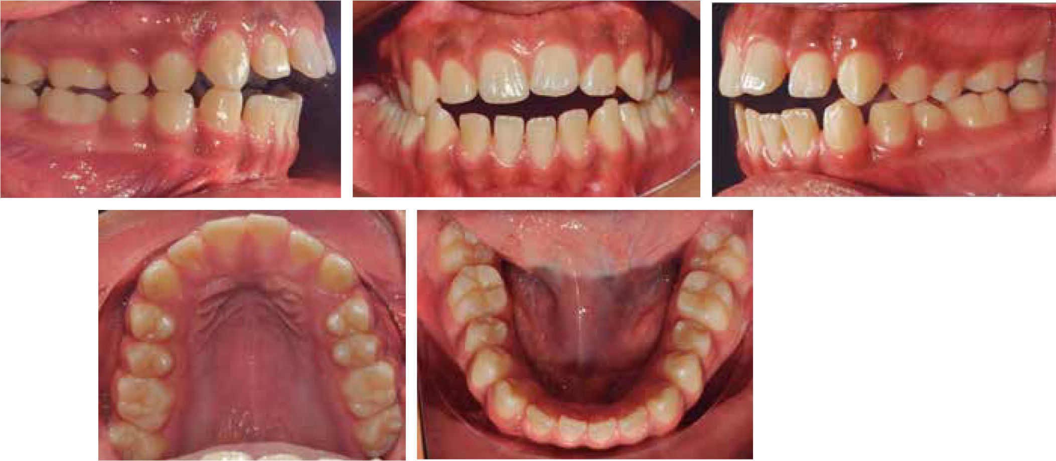 Correction of an skeletal anterior open bite with mini-screws and a ...