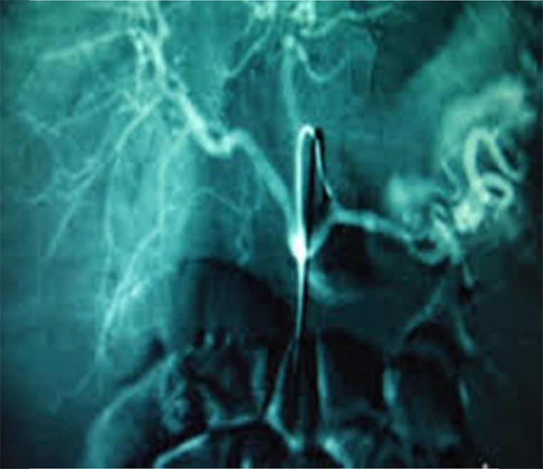 Pancreatic pseudoaneurysms: Forms of presentation and therapeutic ...