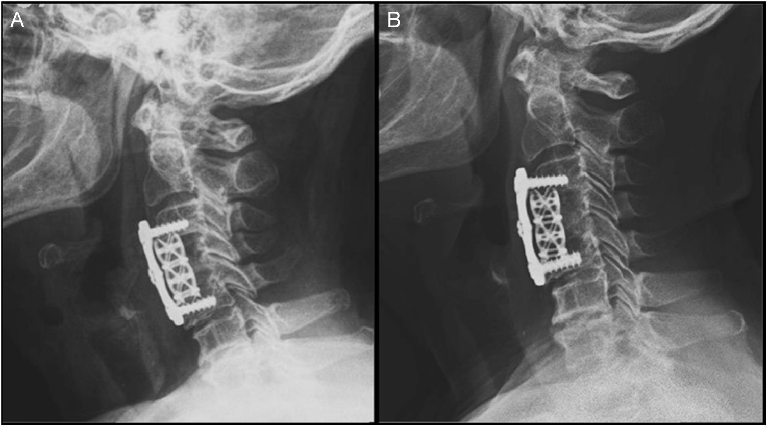 Results to 4-year follow-up of the treatment of the cervical stenosis ...