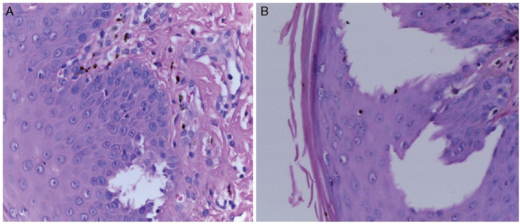 Incontinentia pigmenti with defect in cellular immunity | Boletín ...