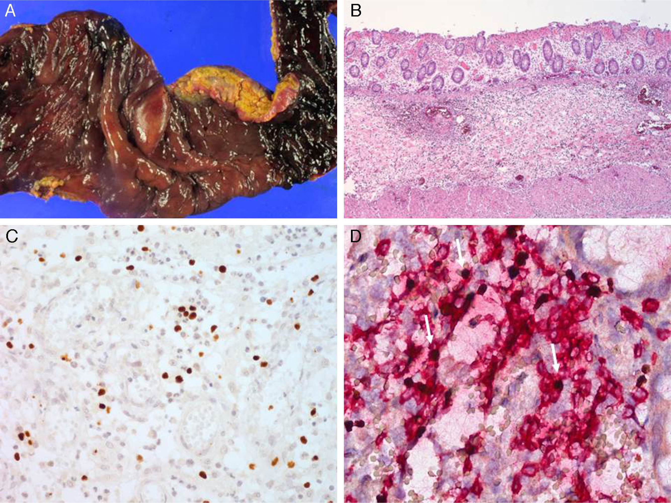 Chronic active EBV infection: the experience of the Samsung Medical ...
