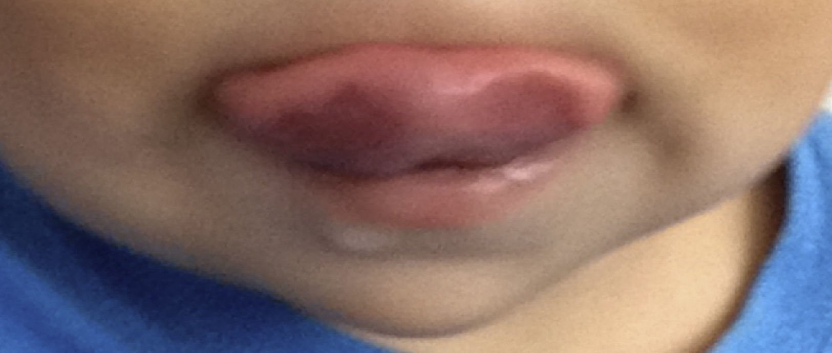 Congenital macroglossia: clinical features and therapeutic strategies ...