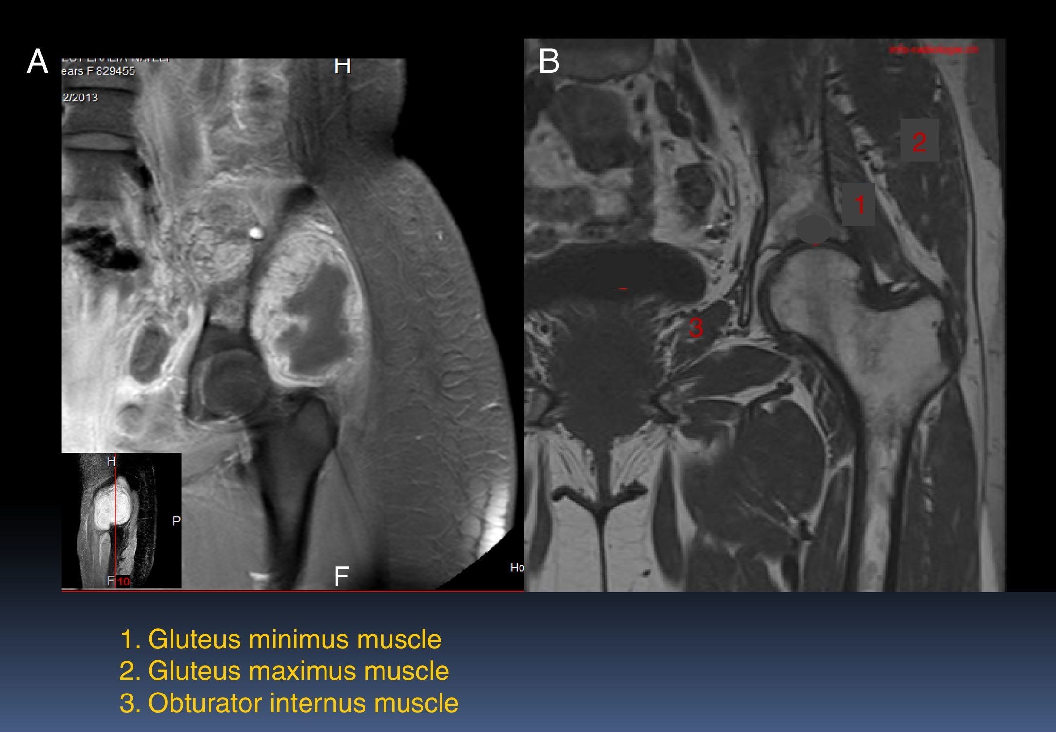 ewing sarcoma radiology