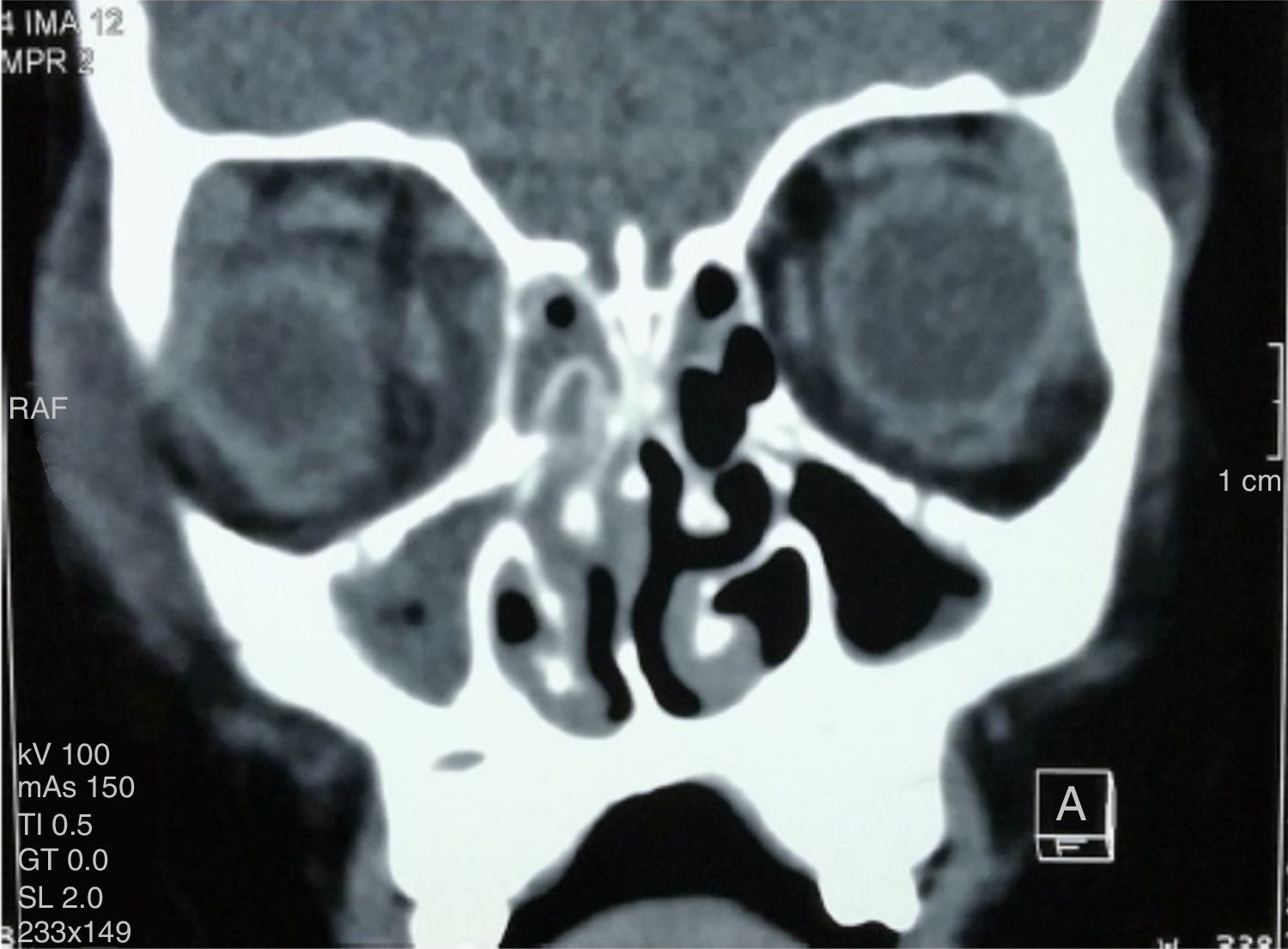 orbital cellulitis ct