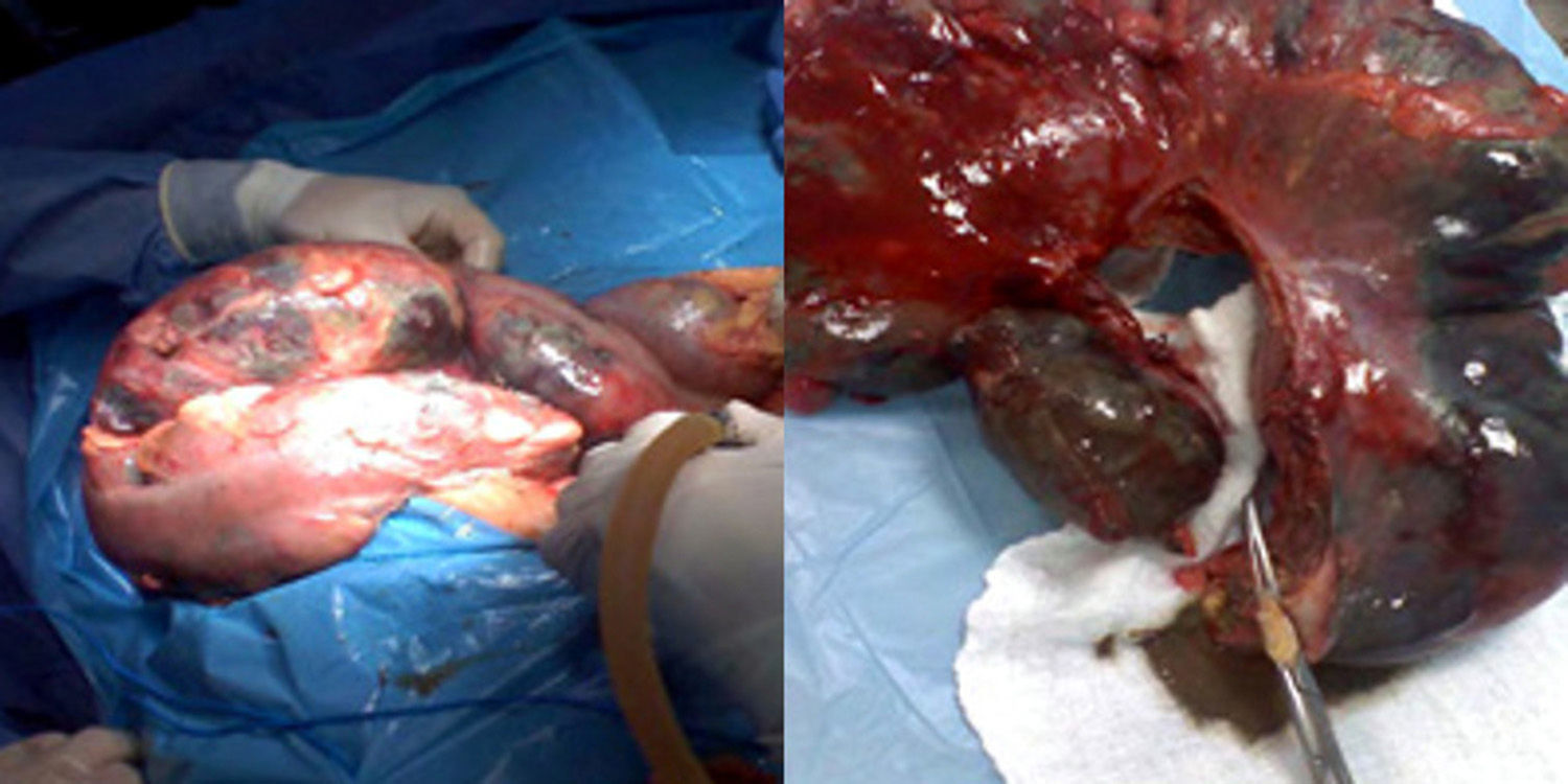 sigmoid volvulus operation