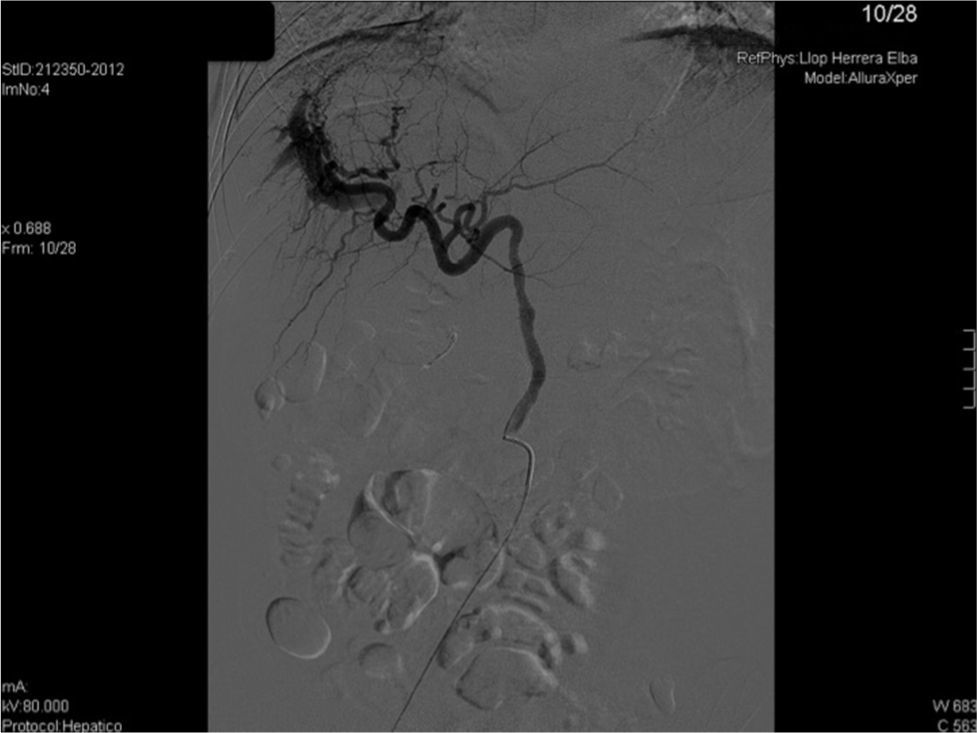 Arterioportal fistula, a rare cause of presinusoidal portal ...