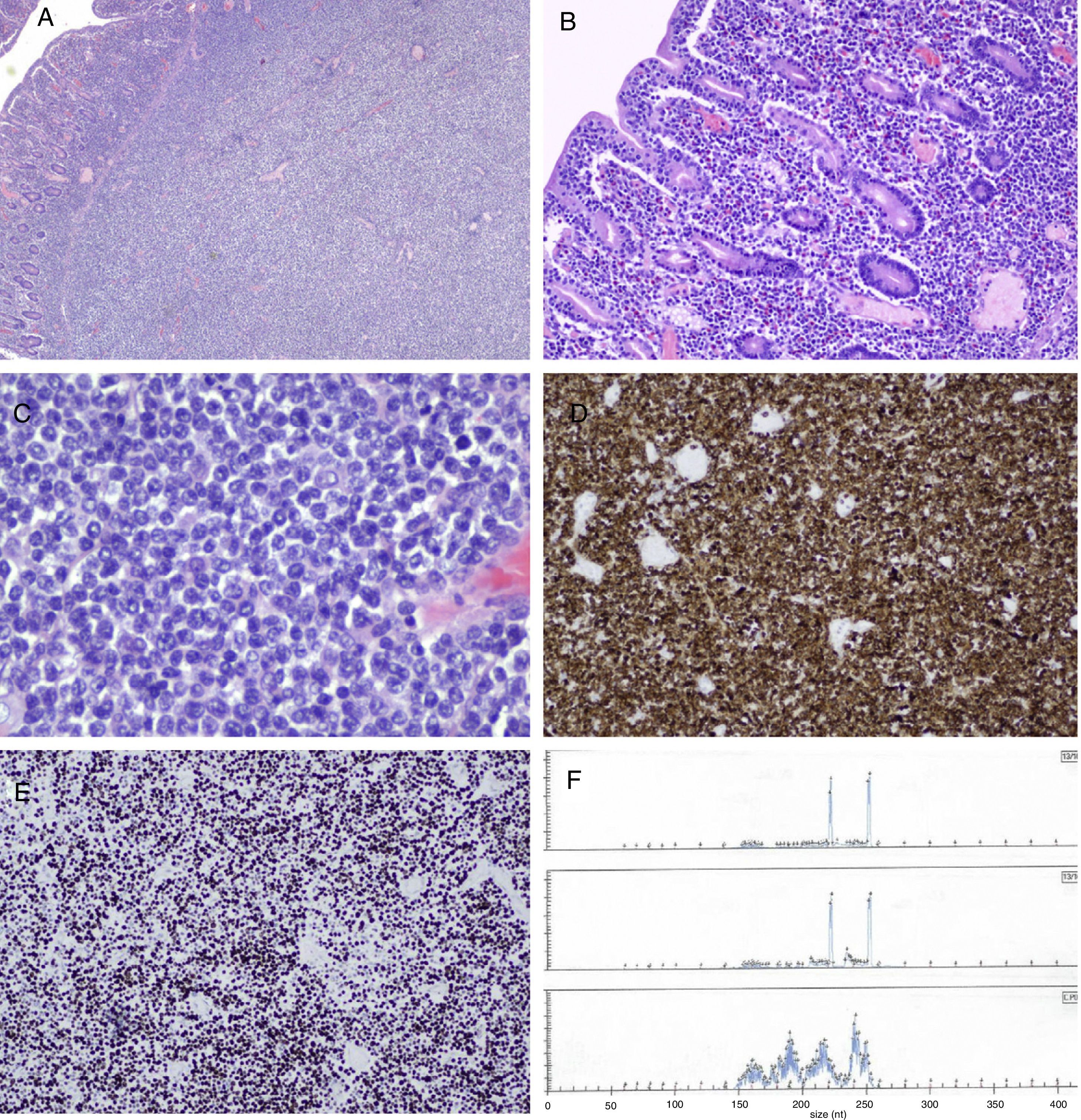 Intestinal perforation secondary to T-enteric lymphoma in a patient ...