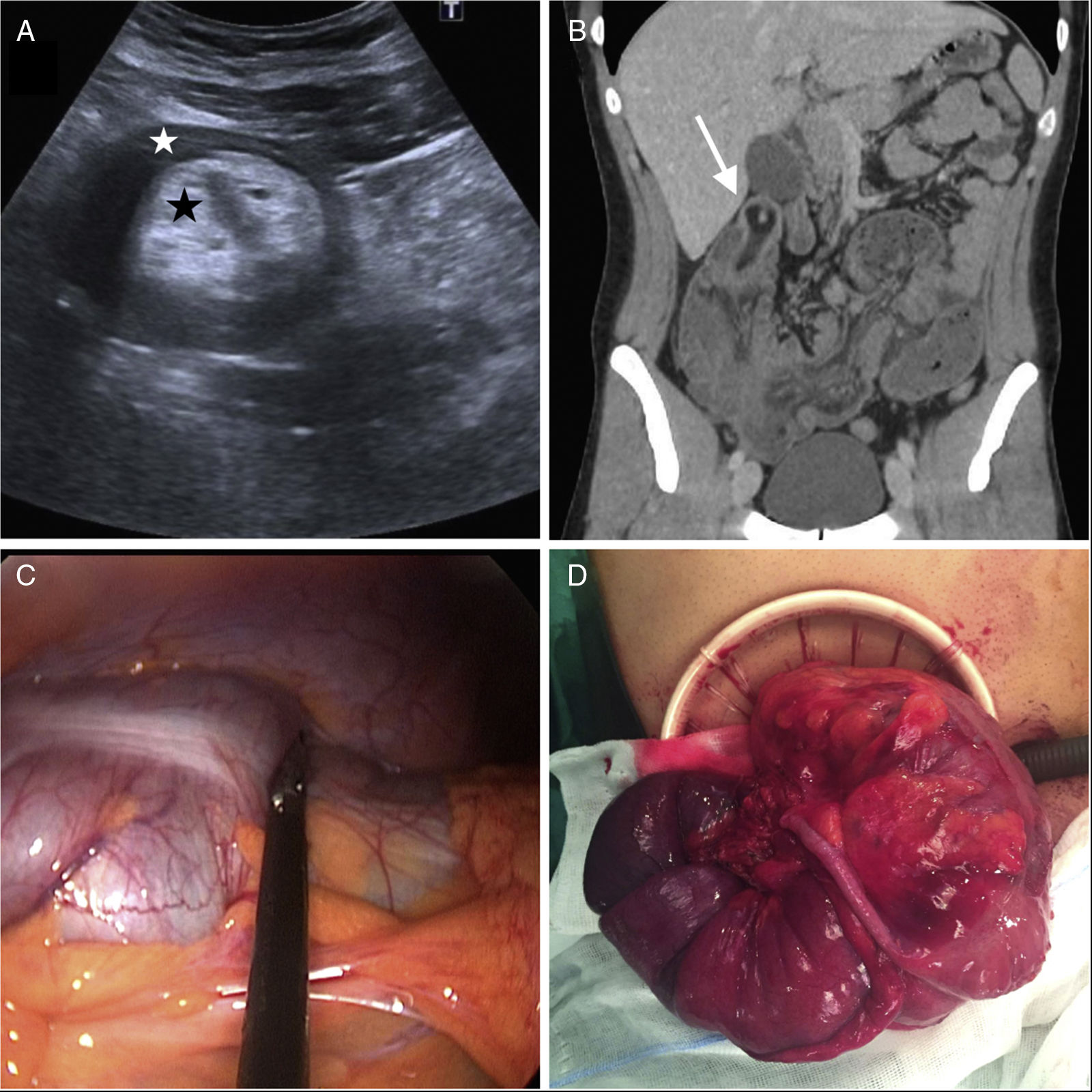 internal intussusception