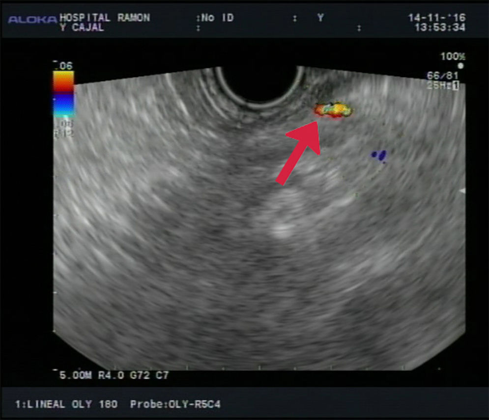 Recurrent gastrointestinal bleeding secondary to Dieulafoy's lesion ...