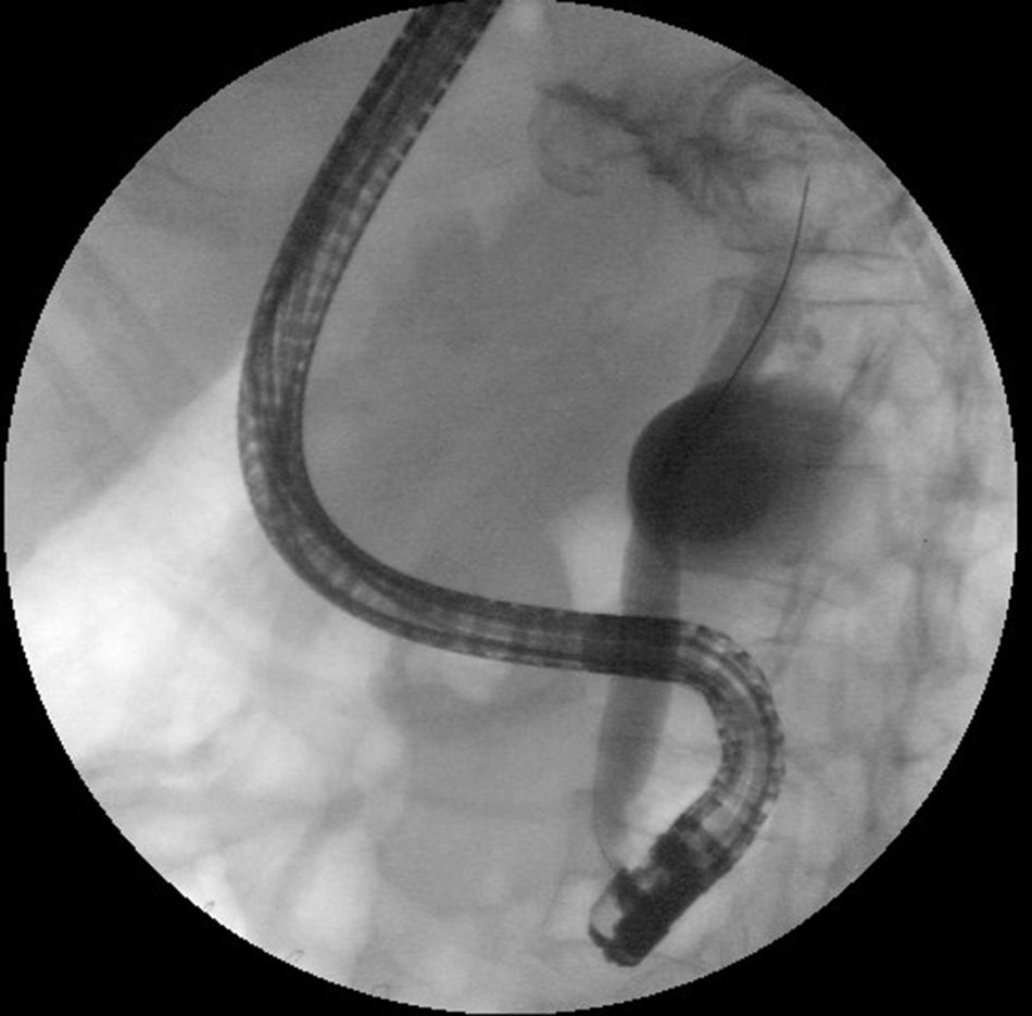 Right hypochondrial pain as a manifestation of a ruptured hepatic ...