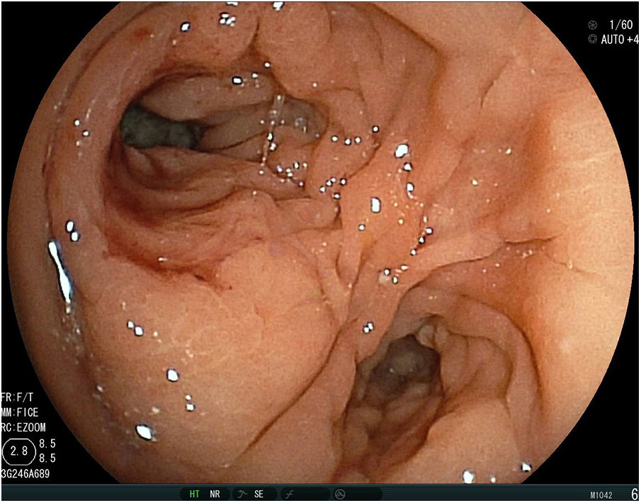 endo sponge procedure