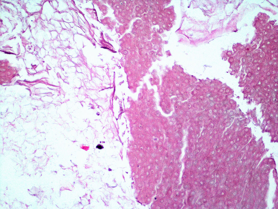 Shadow cells in a cutaneous epidermoid cyst: Searching for a polyposis ...