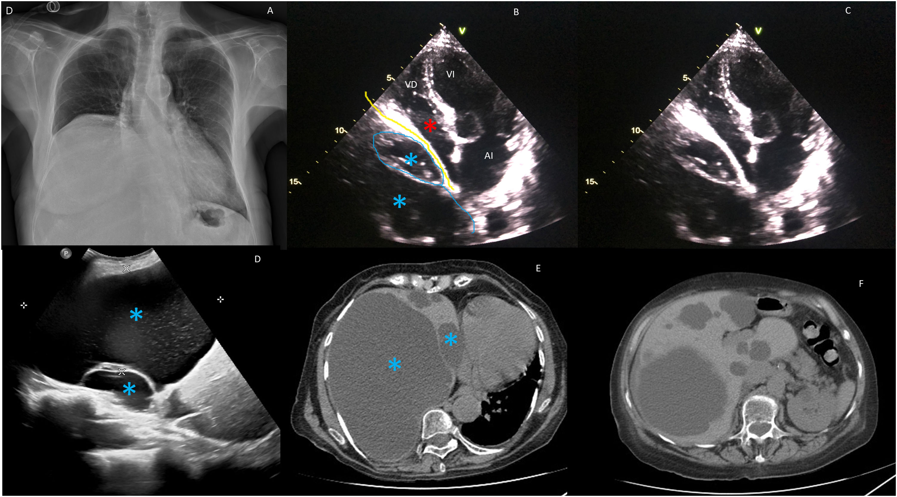Polycystic liver disease, an atypical cause of cardiac tamponade ...