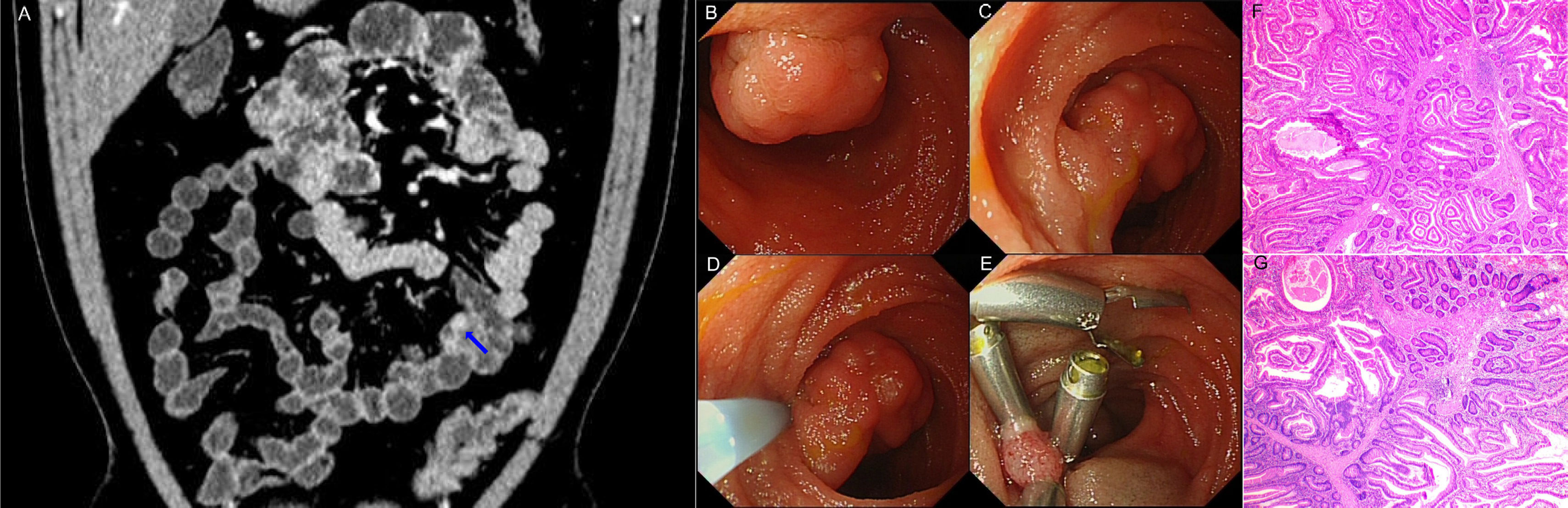 Solitary Peutz-Jeghers hamartomatous polyp in the distal jejunum ...